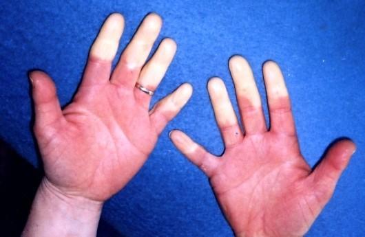 Raynaud’s Syndrome - Fitness Professional Online